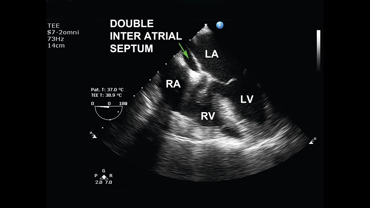 Double Inter Atrial Septum 2014 - YouTube