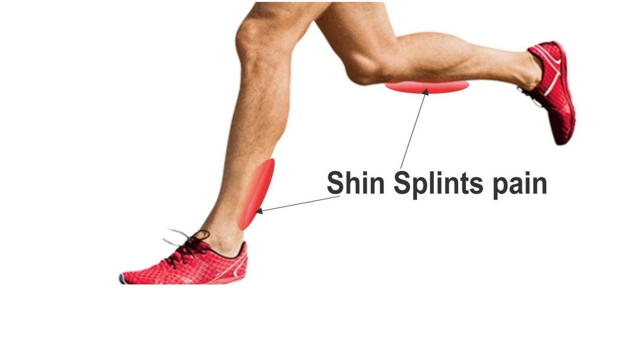 How to Get Rid of Shin Splints Fast - YouTube