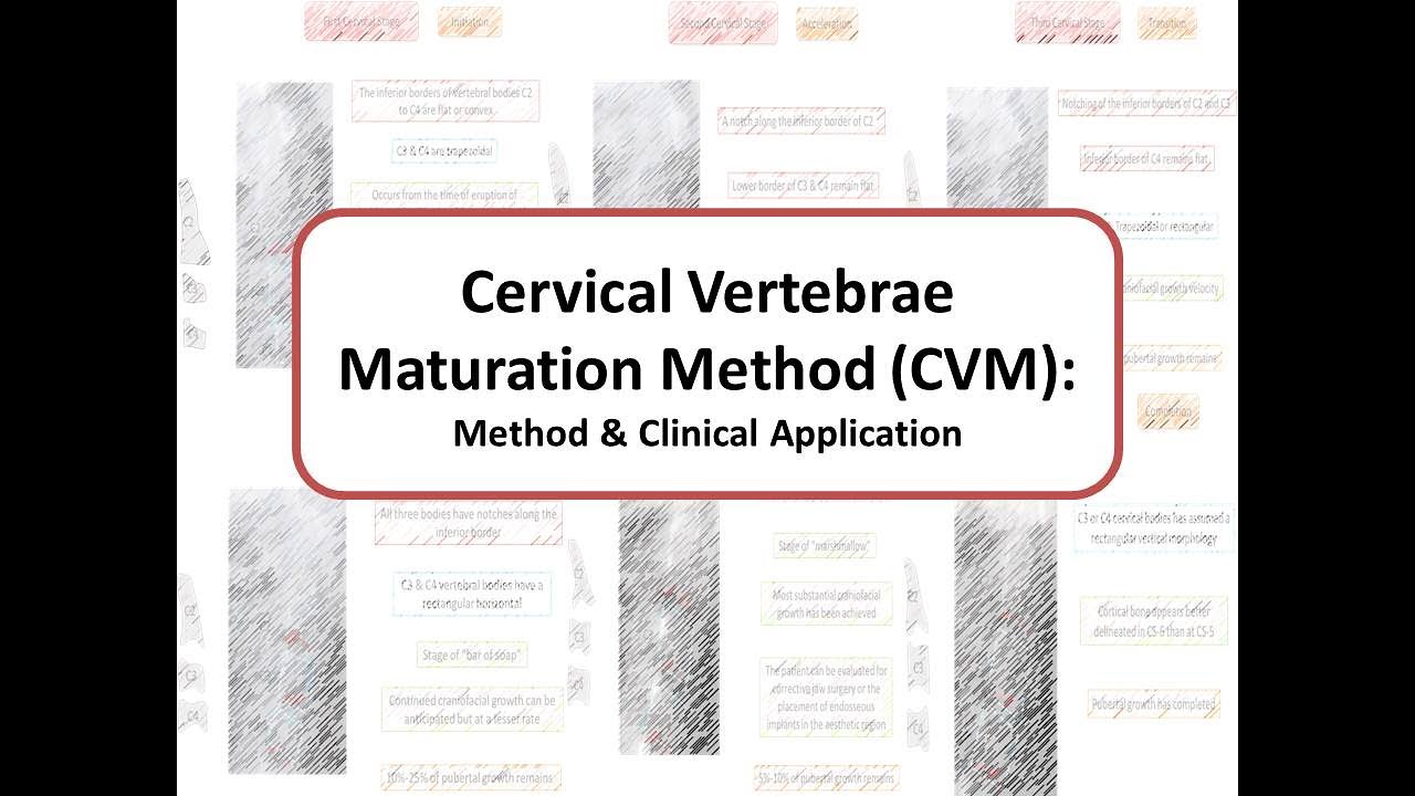 Cervical Vertebral Maturation method (CVM): Method & Clinical ...