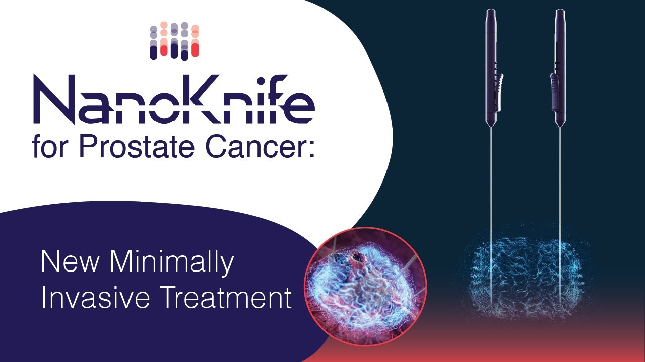 Nanoknife for Prostate Cancer: New Minimally Invasive Treatment - YouTube