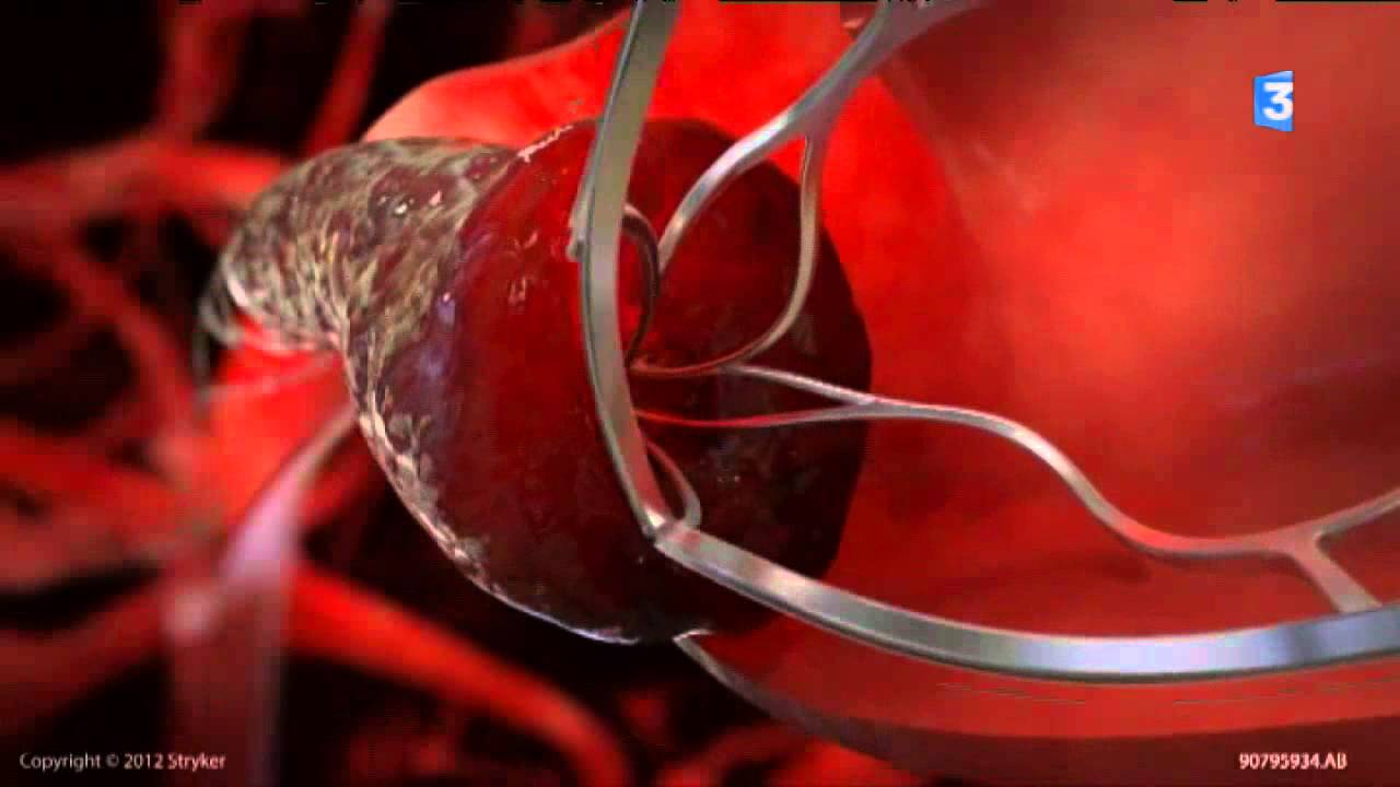 CHU de Bordeaux : Un nouveau traitement de l'AVC - YouTube