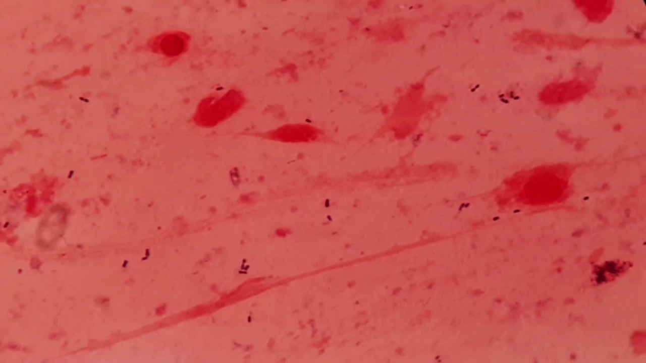 Sputum Under The Microscope Showing Gram Positive Diplococci My Xxx Hot Girl