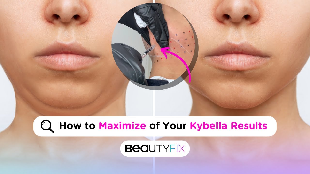 What to do AFTER Getting Kybella? | BeautyFix - YouTube