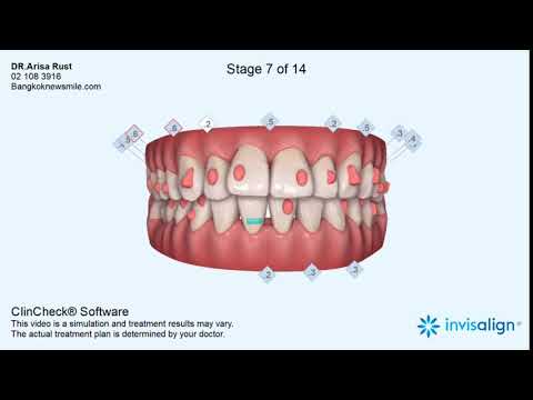 Invisalign Outcome Simulation August 2017. จัดฟันแบบใสถอดได้ Invisalign ...
