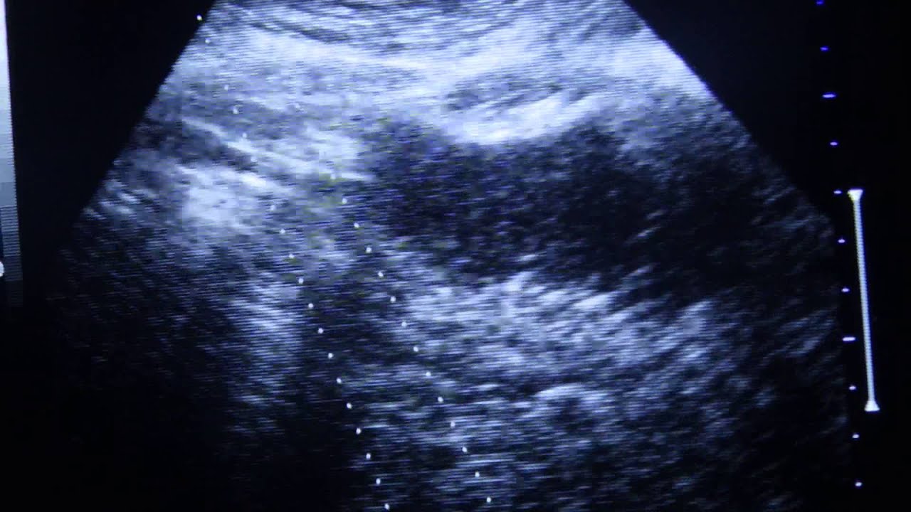 Half filled stomach - YouTube