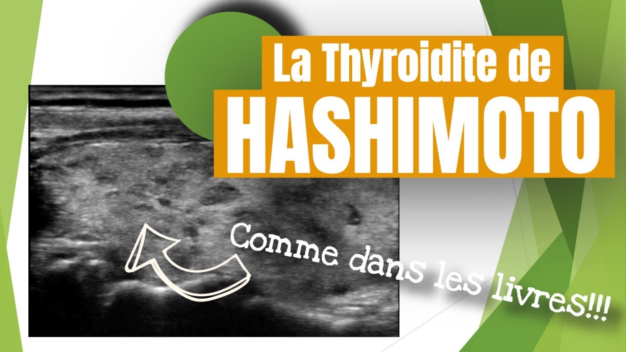 "Peau de Leopard": thyroidite de Hashimoto en échographie - YouTube