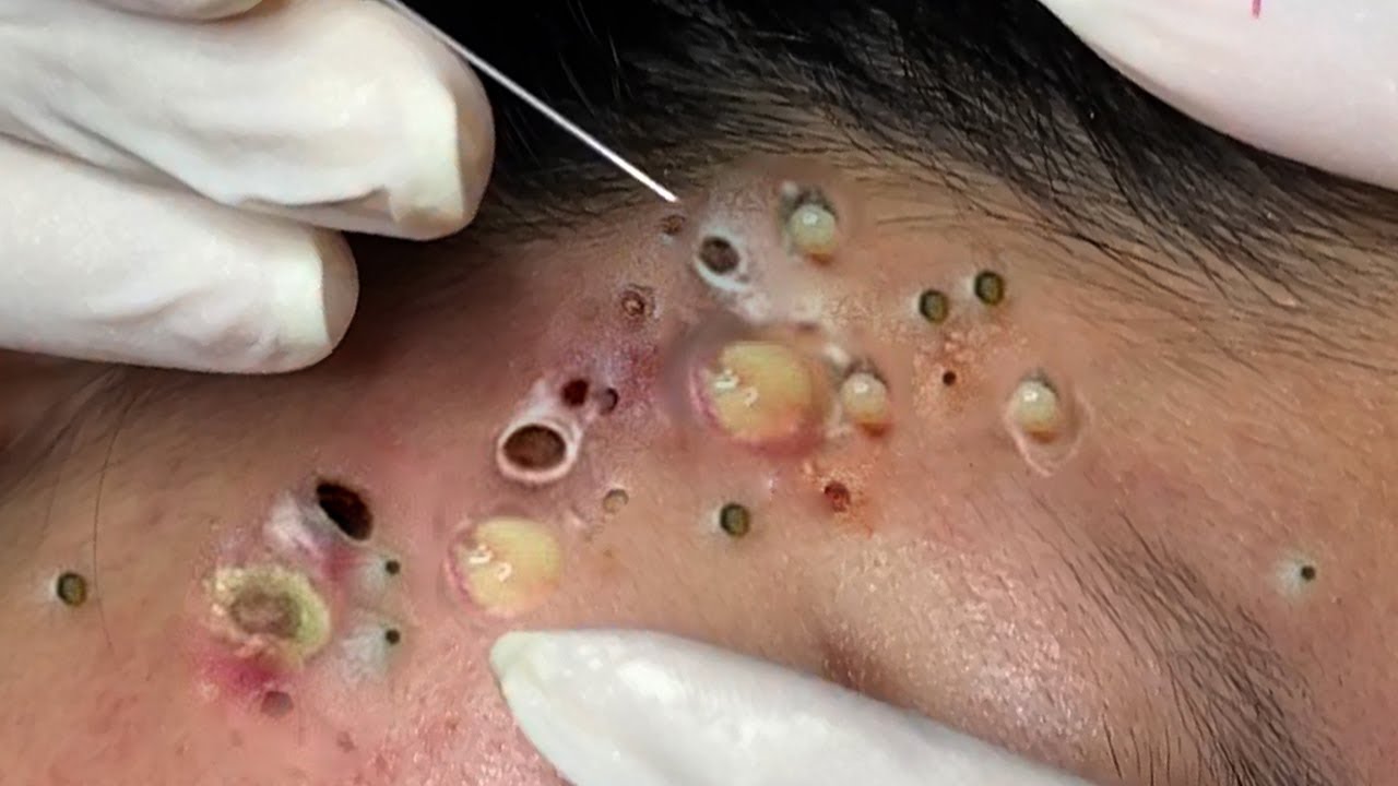 Close-Up Blackhead Removal from Deep Facial Pores #076 - YouTube