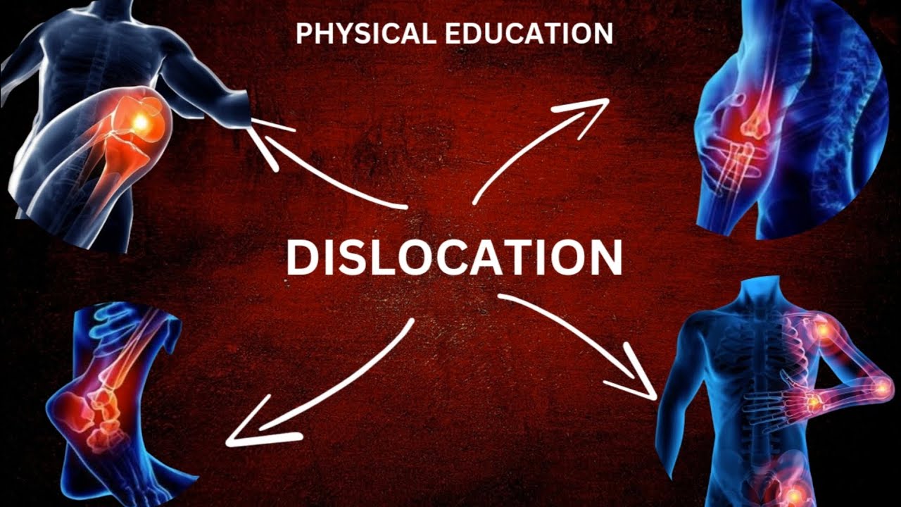 Dislocation and its Prevention by Suraj Singh. Anatomy and Physiology ...