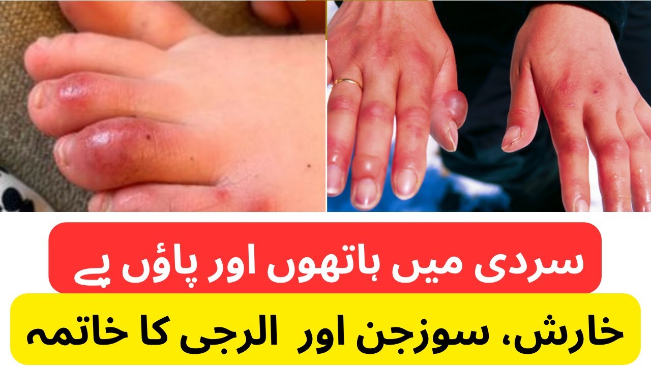 Hath aur Paon mein Kharish ka ilaj| Treatment of itching on hands and ...