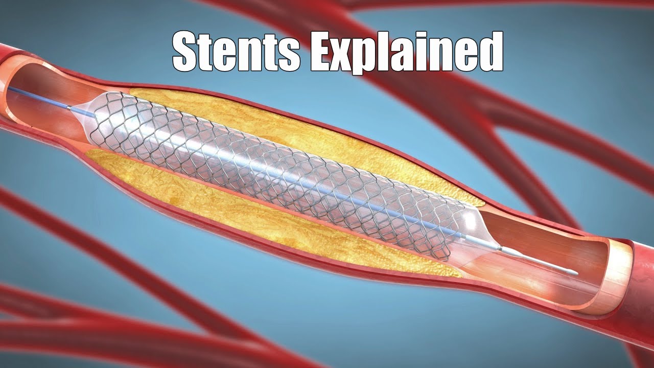 What is a stent? (3D animation) - YouTube