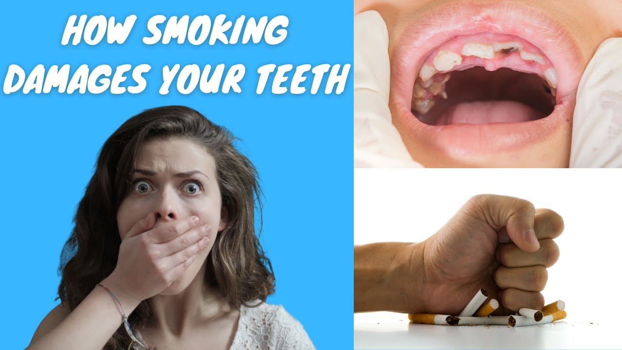 How Smoking Damages Your Teeth | Save Your Smile - YouTube