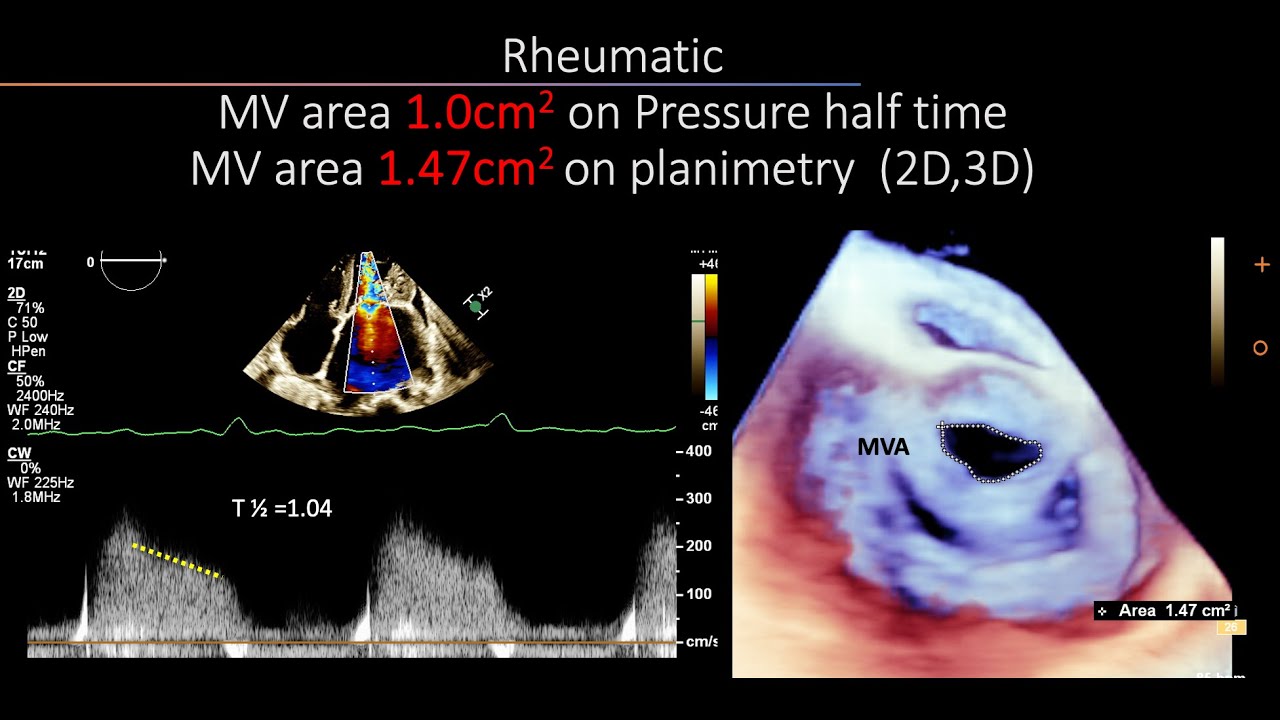 In Mitral Stenosis, disparity between various methods to assess MV area ...