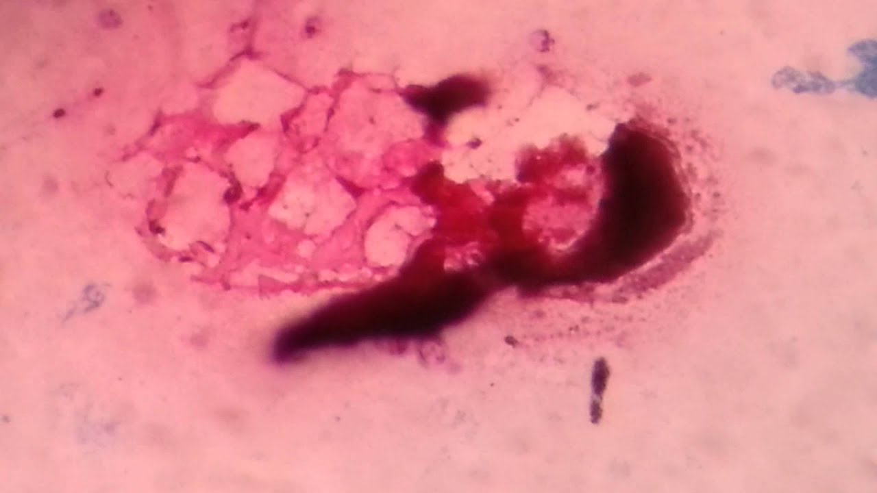 Nocardia asteroides under acid fast stained slide - YouTube