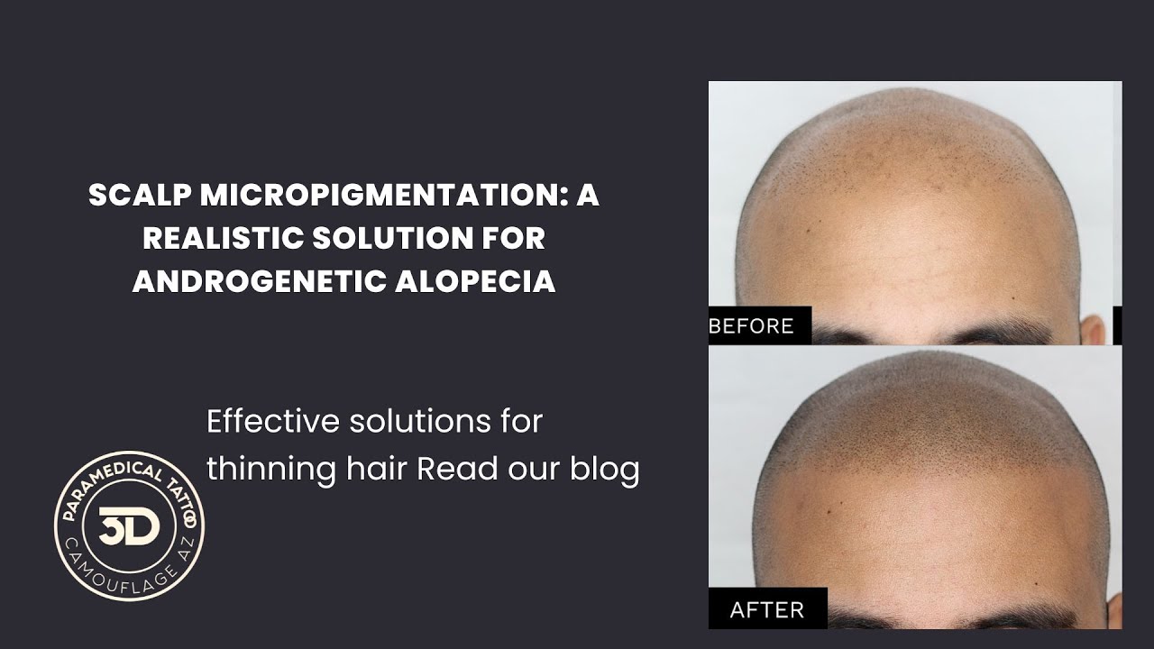 🚨 Struggling with hair loss? Androgenetic alopecia (aka male and female ...