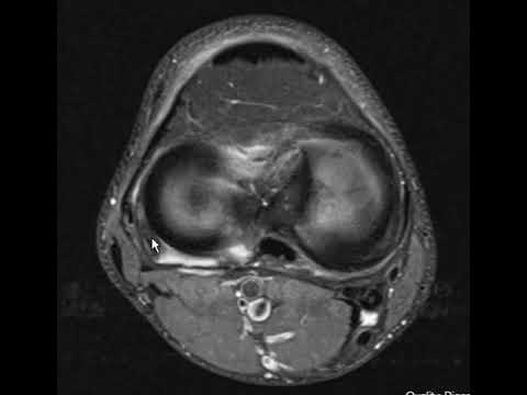 Fibular collateral ligament sprain and meniscus fascicle tear - YouTube