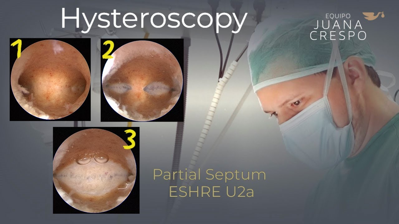 Partial Septum Resection - YouTube