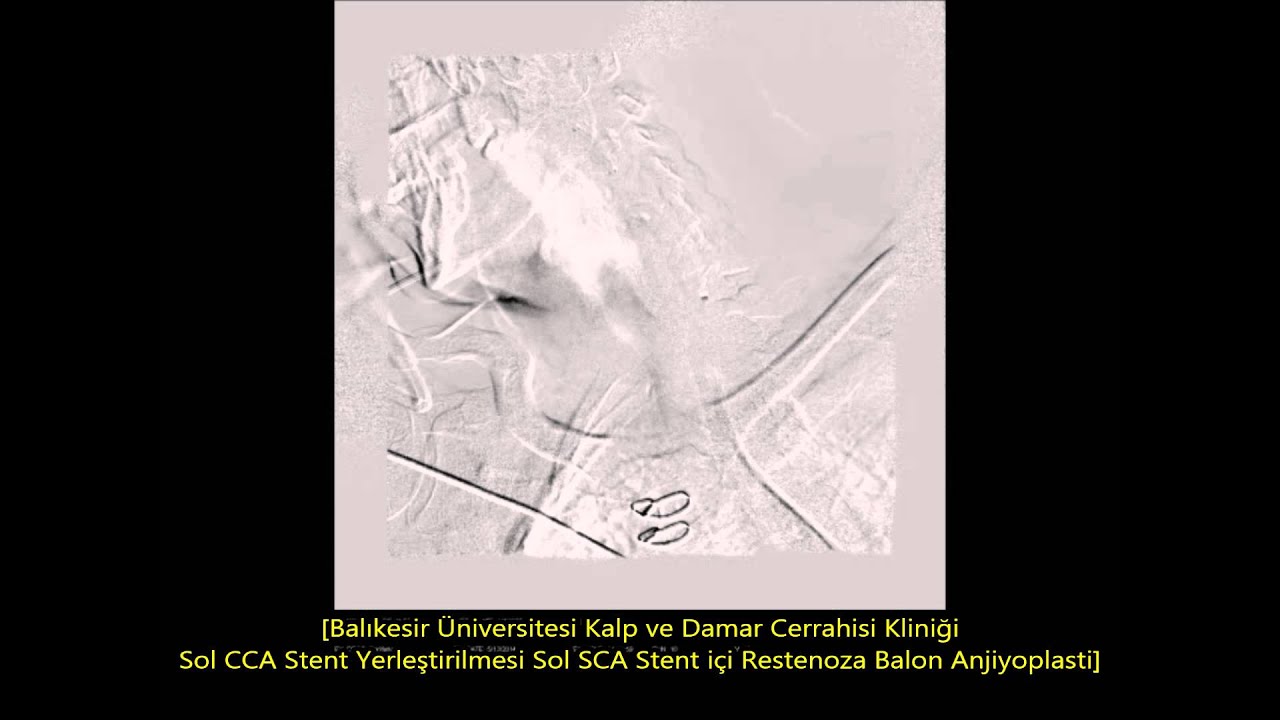 CCA stent SCA stent içi restenoza Balloon AP - YouTube