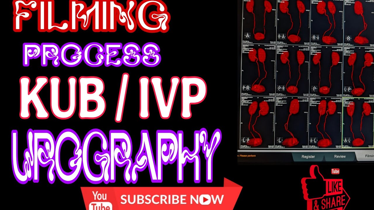 CT SCAN KUB Contrast || Urography || IVP Filming process on United ...