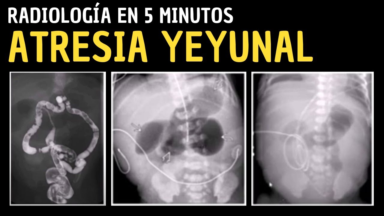 Radiología en 5 minutos: Atresia yeyunal. - YouTube