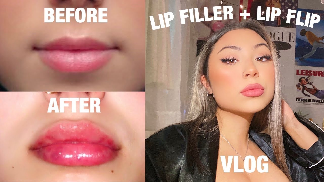 Getting Lip Injections Lip Flip 1 Syringe Vlog Youtube