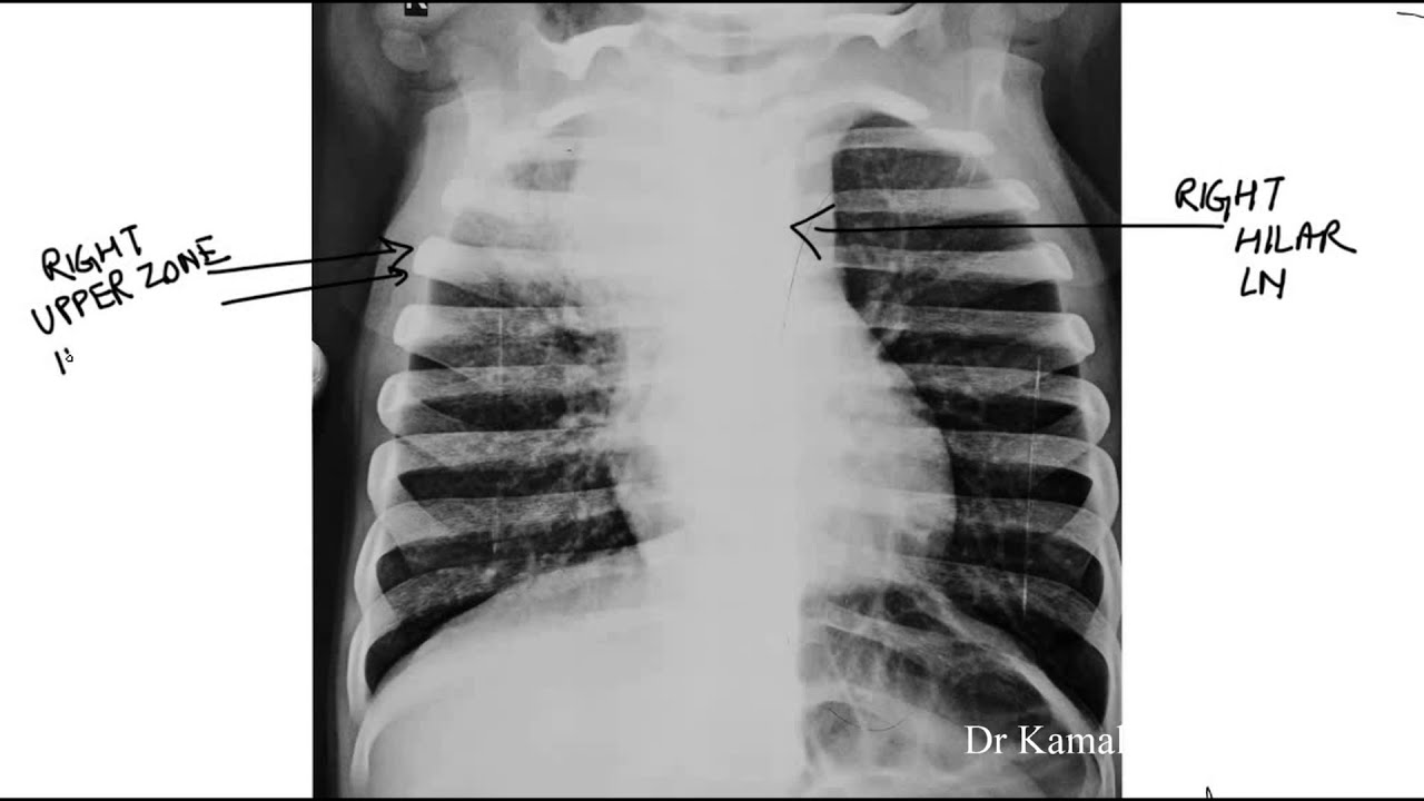 Ghon's complex - YouTube