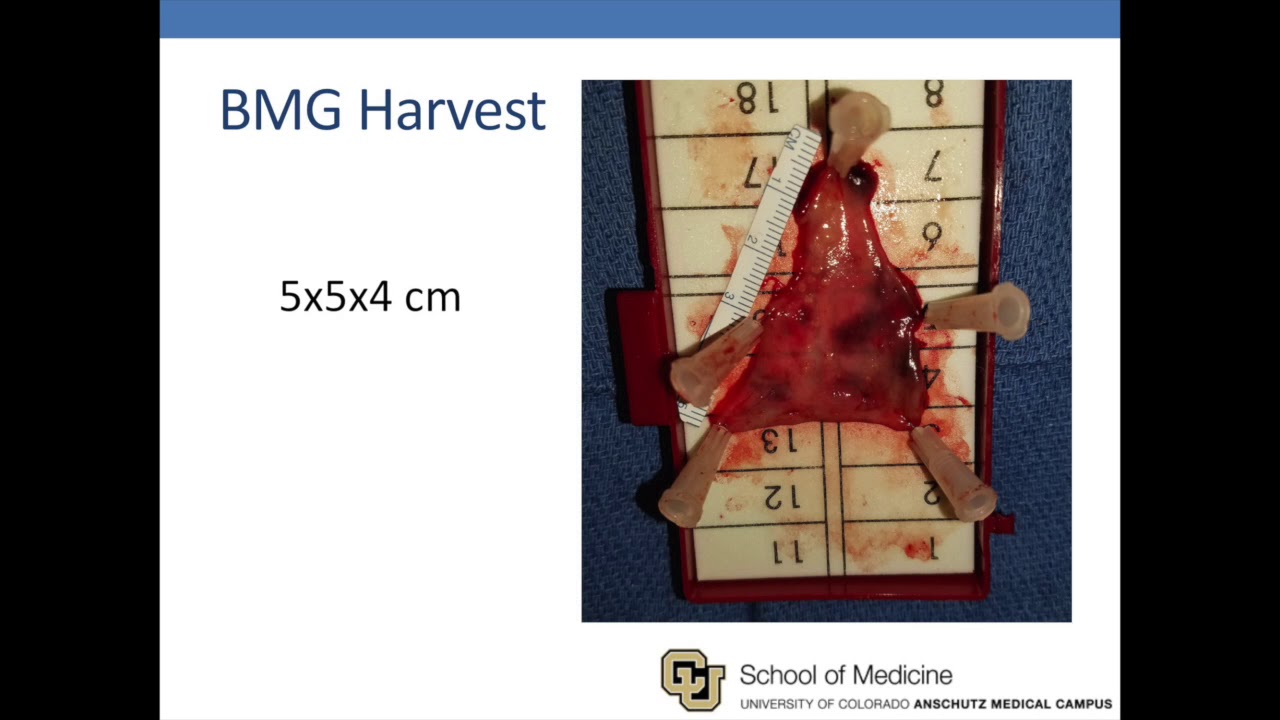 Flynn Technique for Bladder Neck Reconstruction: Robotic Subtrigonal ...