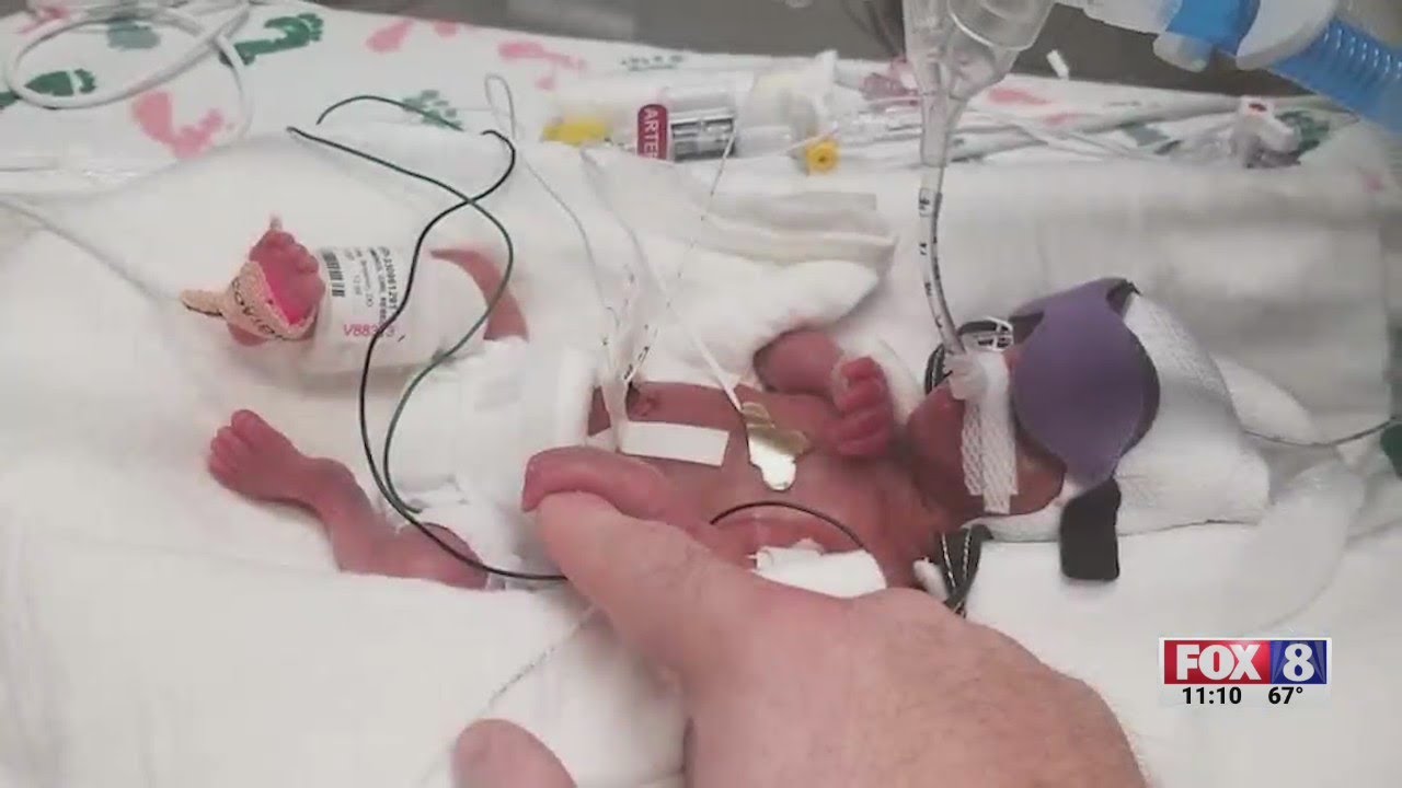 ‘He is like a miracle baby’: Micro-preemie baby makes ‘super’ recovery ...
