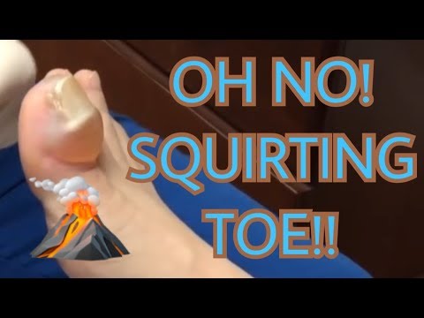 Huge Blister on Big Toe Popped and Toenail removed. Nail Removal. - YouTube