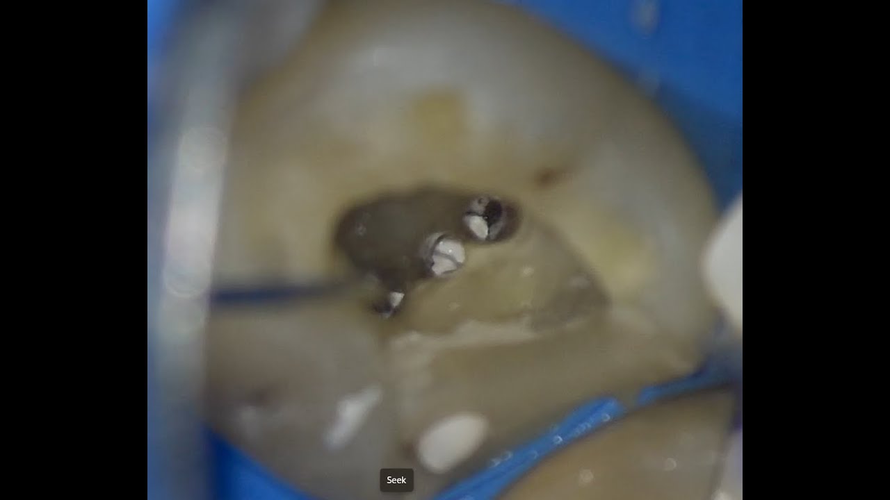 Lower First Molar With Six Root Canals - YouTube