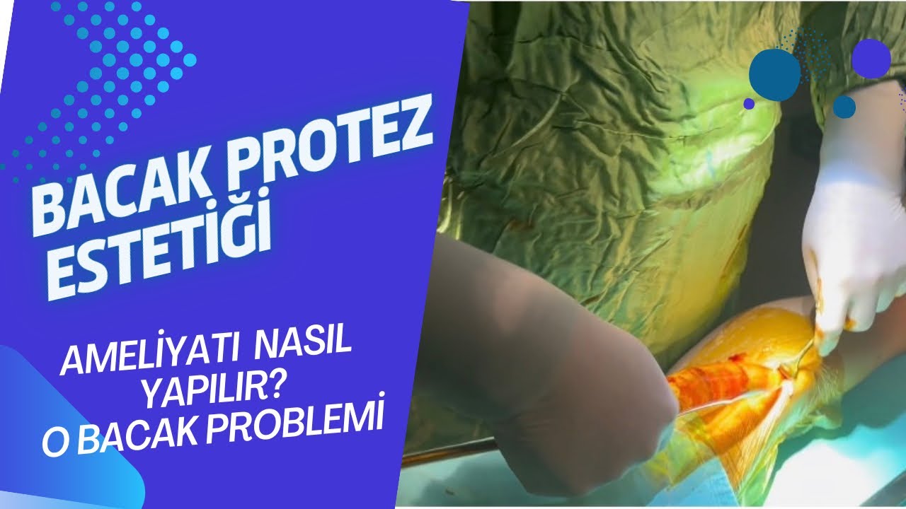 Bacak Protez Estetiği: Nasıl yapılır ? O Bacak Problemi - YouTube