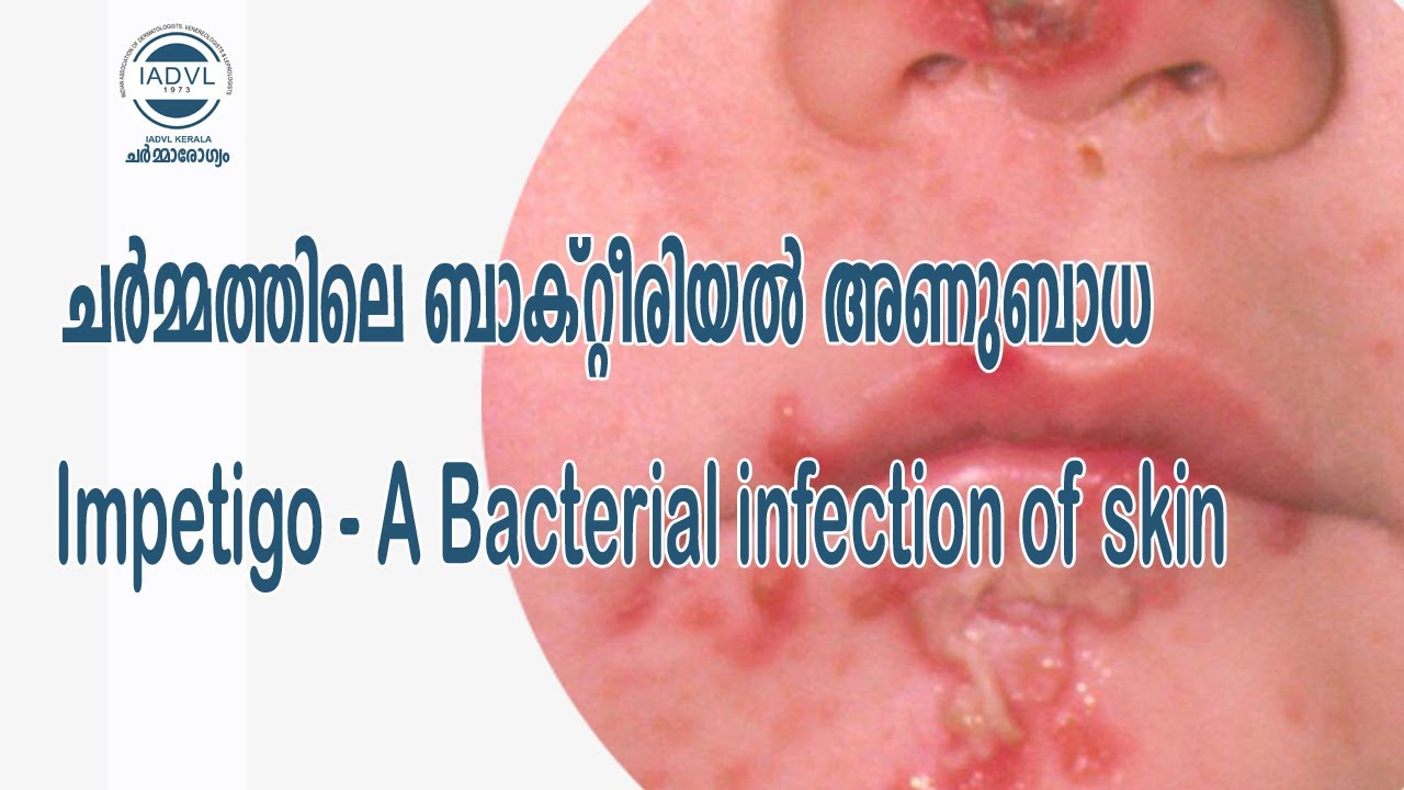 Impetigo-A Bacterial infection of skin ചർമ്മത്തിലെ ബാക്റ്റീരിയൽ അണുബാധ ...