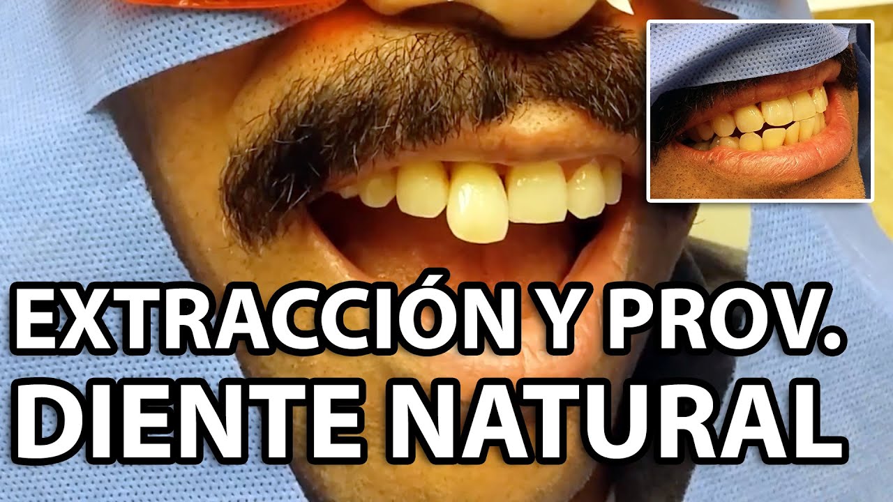 DIENTE NATURAL como PROVISIONAL 👅 FERULIZADO #dentaltip #dental - YouTube