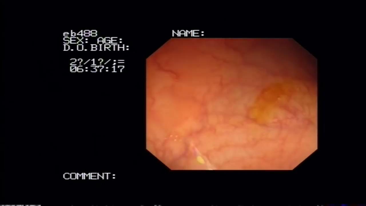 1 Oxiurose - YouTube