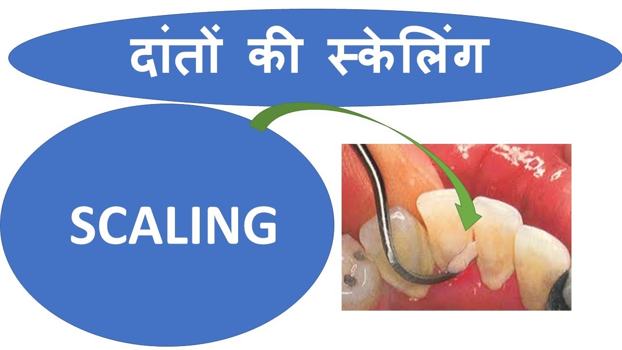 WHAT IS SCALING OF TEETH HOW IS SCALING OF TEETH DONE दांतों की ...