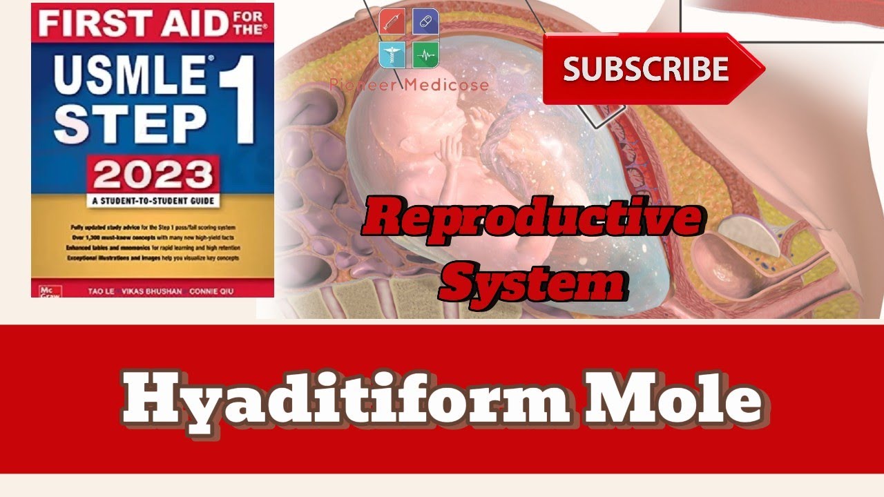 Hydatidiform mole, complete, partial mole from Step 1|Reproductive ...