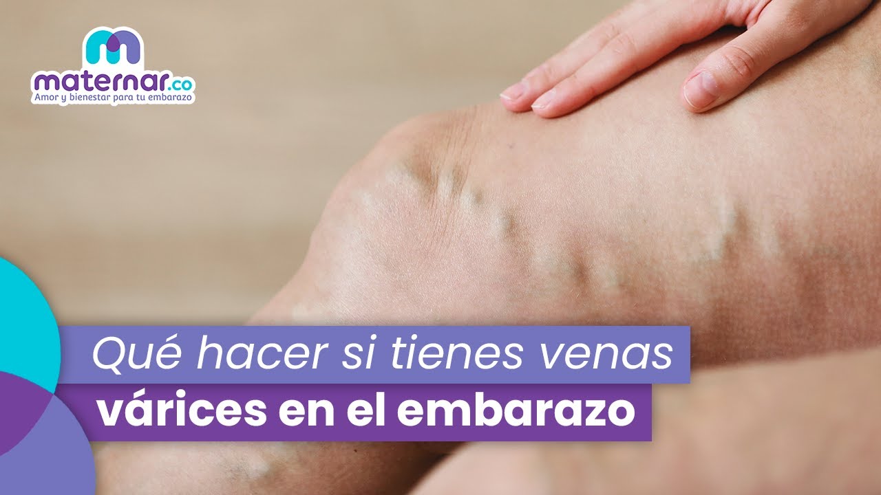¿Cómo evitar las venas várices durante el embarazo? | Maternar.co - YouTube