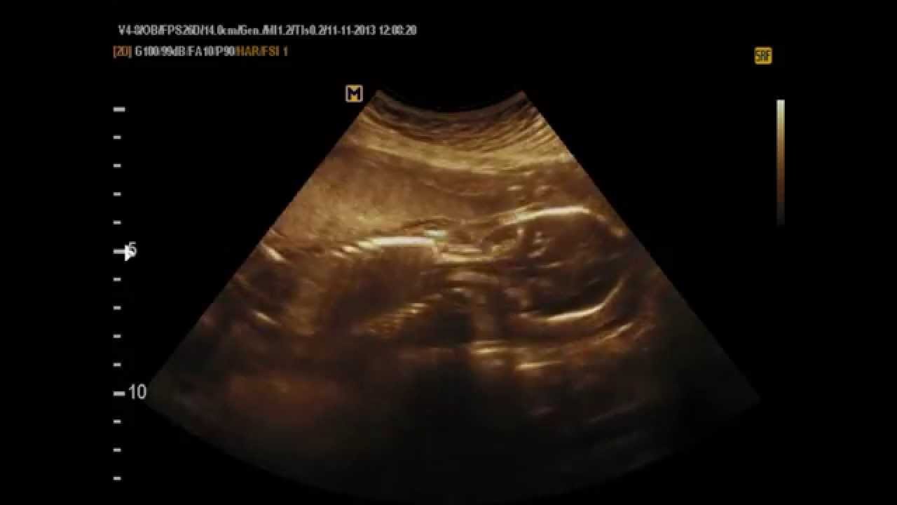 Sindrome De Oligoidramnio Potters