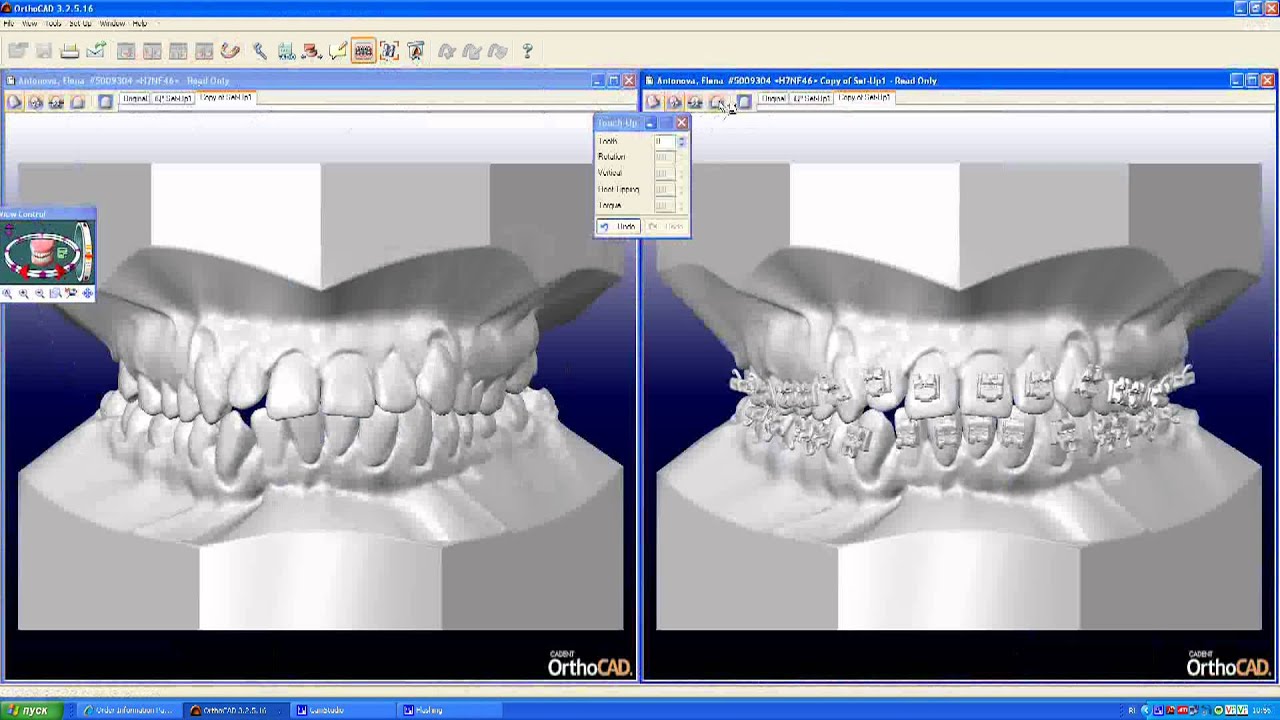 Orthocad.avi - YouTube