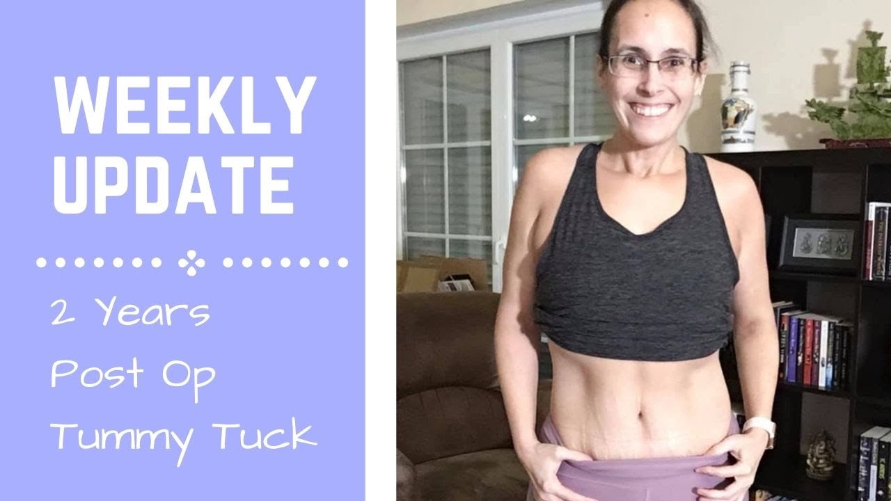Weekly Update/2 Years Post Op Tummy Tuck - YouTube