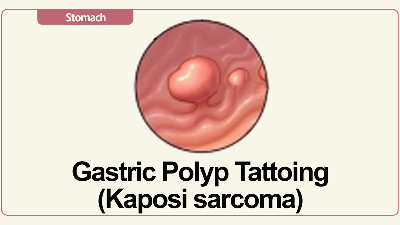 Gastric Polyp Tattooing (Kaposi Sarcoma) - YouTube