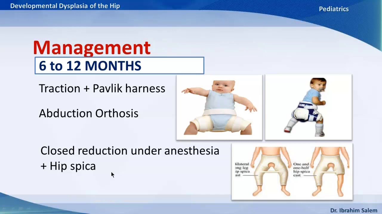PT 13 DDH management 6 to 12 months - YouTube