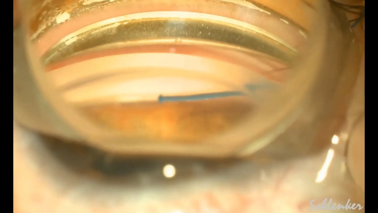 Gonioscopy Assisted Transluminal Trabeculectomy (GATT) as 1st Line ...