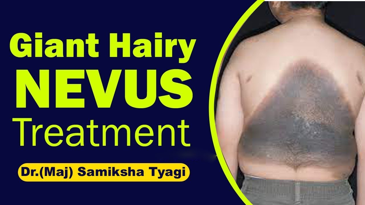 Giant Hairy Nivus or Treat Congenital Melanocytic nevus | Giant Facial ...