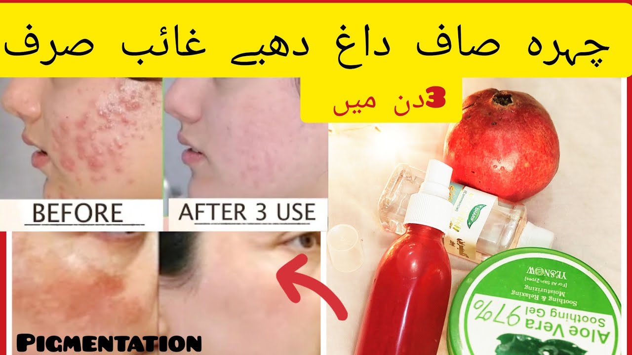 Diy toner to remove dark spots pigmentation & Melasma! best pomegranate ...