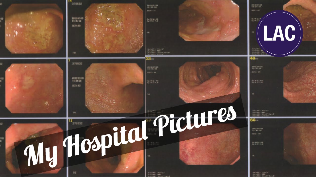 My Healed Colon & Hospital Pictures | Ulcerative Colitis - YouTube