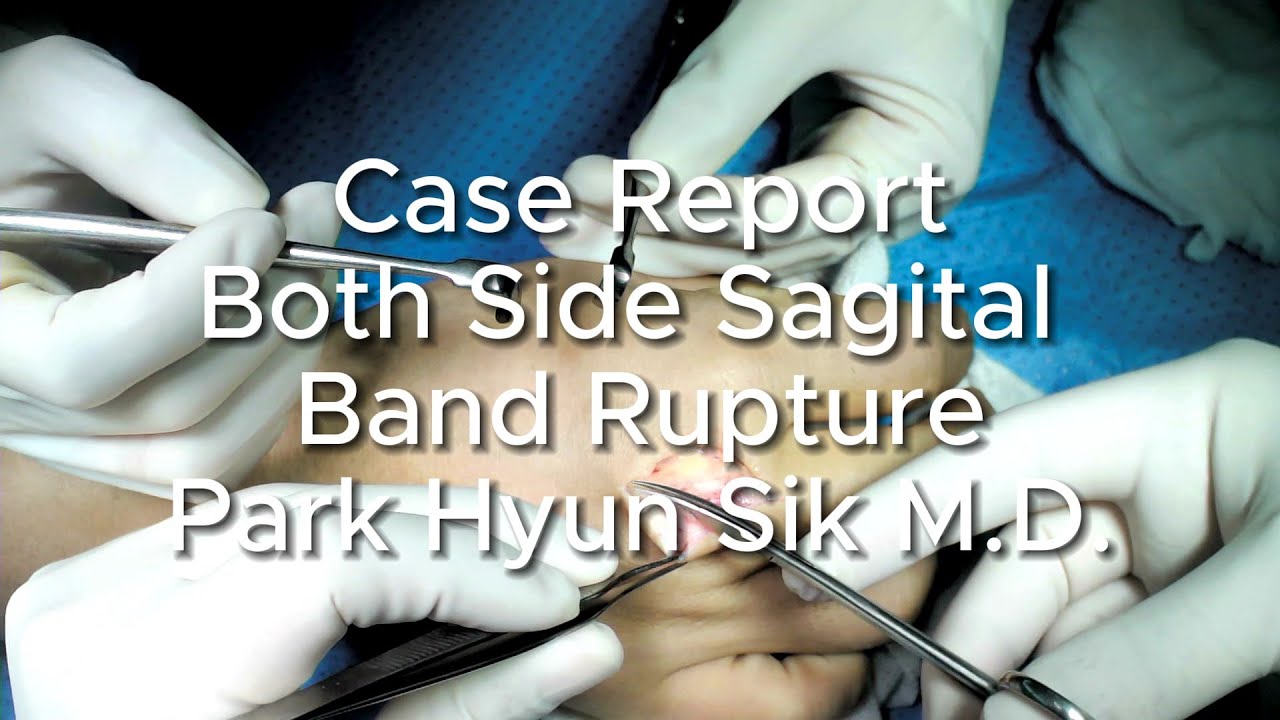 Case Report Both Side Sagital Band Rupture - YouTube
