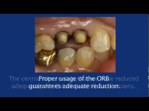 The Occlusal Reduction Bur - Demonstration of Use - YouTube