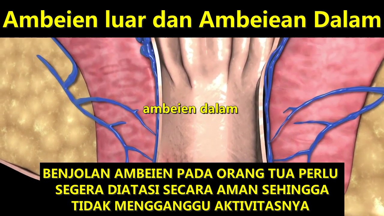 Mengobati Benjolan Ambeien Pada Orang Tua - YouTube