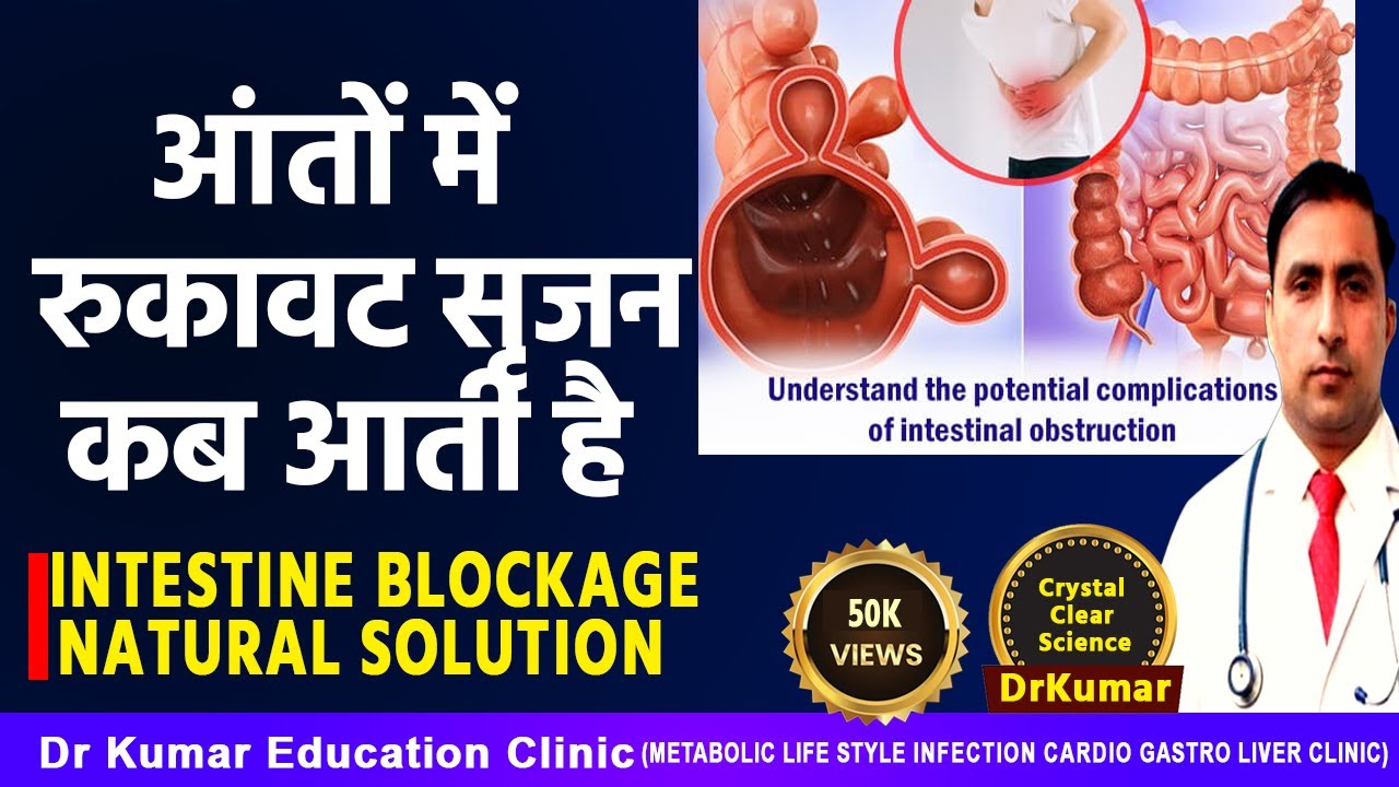 आंतों में रुकावट सृजन कब आती है INTESTINE BLOCKAGE.|| CHRONIC ...
