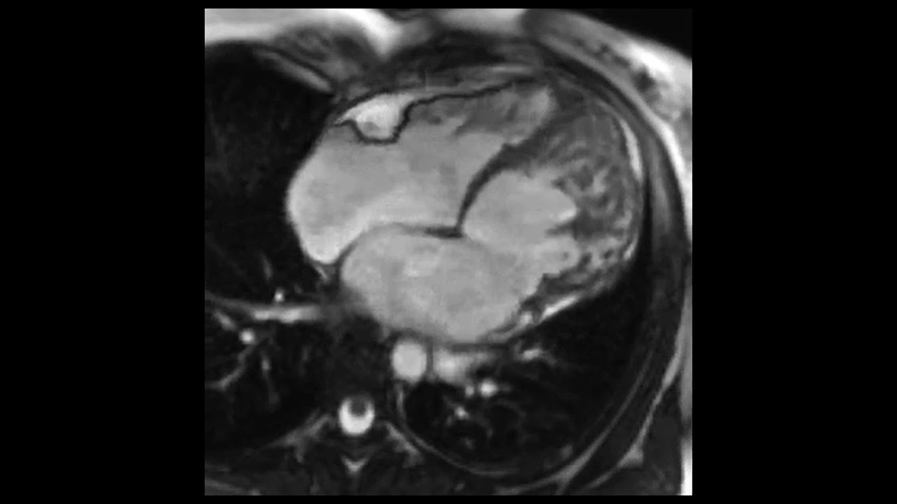 Left Ventricular Noncompaction - YouTube